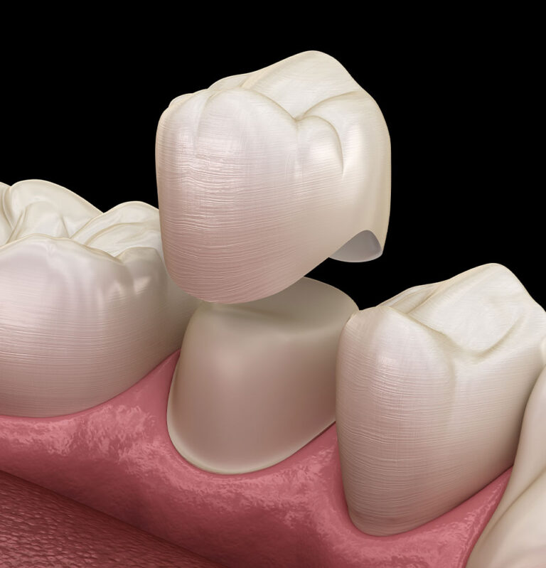 Dental Crowns Vancouver, BC | Tooth Crown | ARCH Dental + Aesthetics